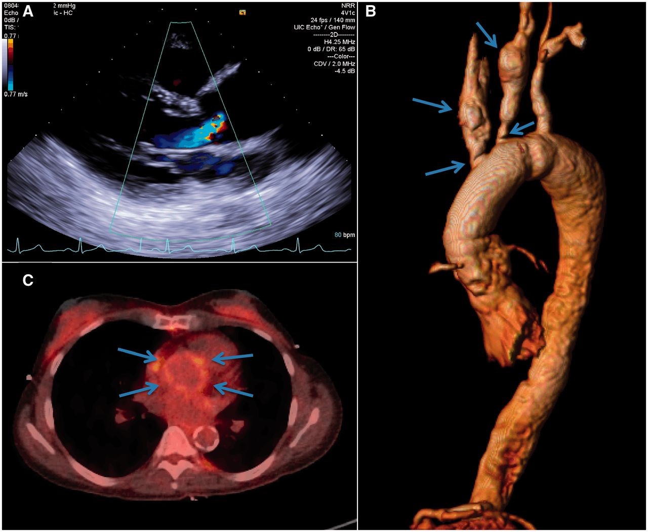 Diadnóstico Arteritis Takayasu - Ciclo Imagen para el Diagnóstico y ...