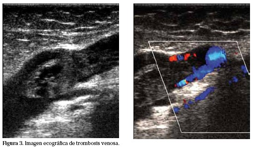 "Trombosis Venosa Profunda", por Irene Palomera.