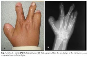 Sindáctilia. - Ciclo Imagen para el Diagnóstico y Medicina Nuclear